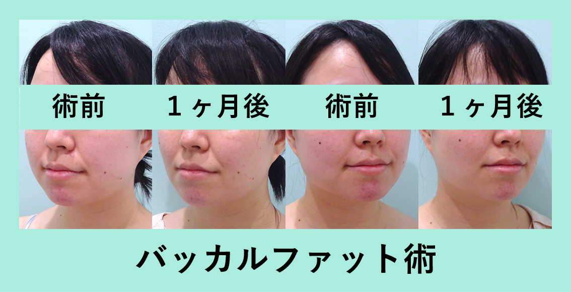 笑ったときの丸顔解消!「バッカルファット」 東京・銀座の美容外科クリニック|wom Clinic Ginza